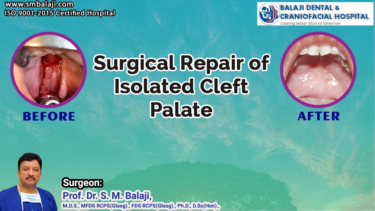 Surgical Repair of Isolated Cleft Palate - YouTube