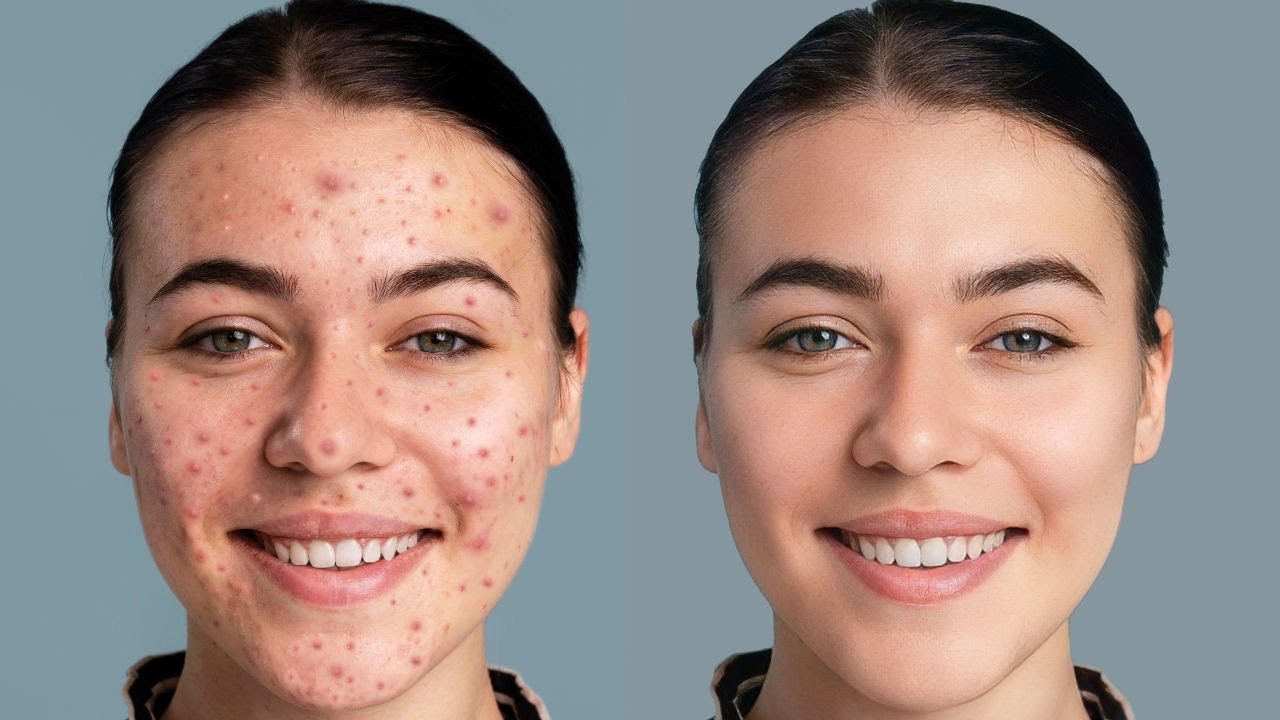 Face retouching - Remove pimple from face | Skin Retouching 2023 - YouTube