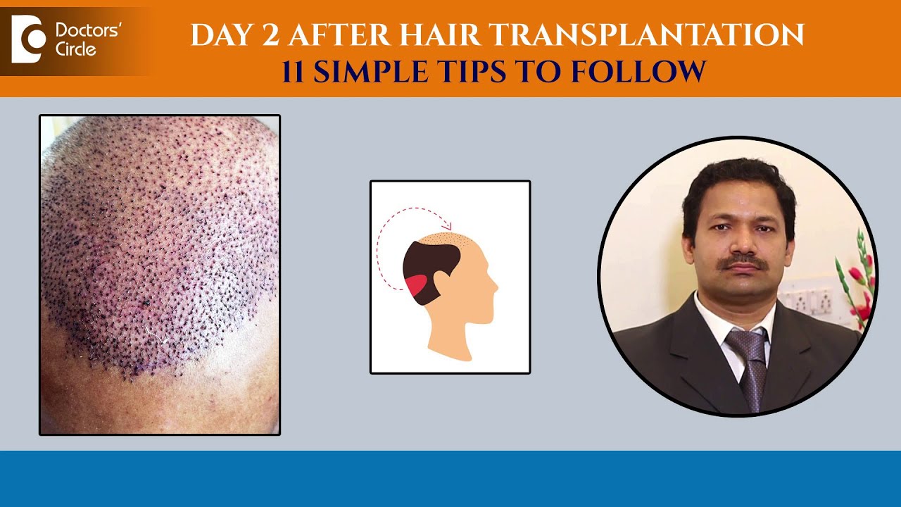 Day 2 After Hair Transplant Saline Spray After Hair Transplant Dr