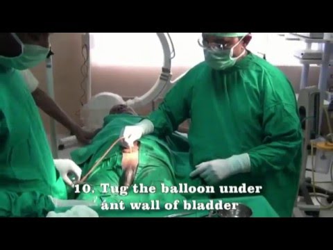 Trocar suprapubic cystostomy - YouTube