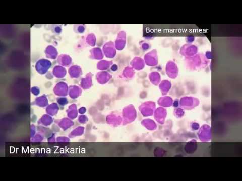 Acute Myeloid Leukemia AML M3 - YouTube