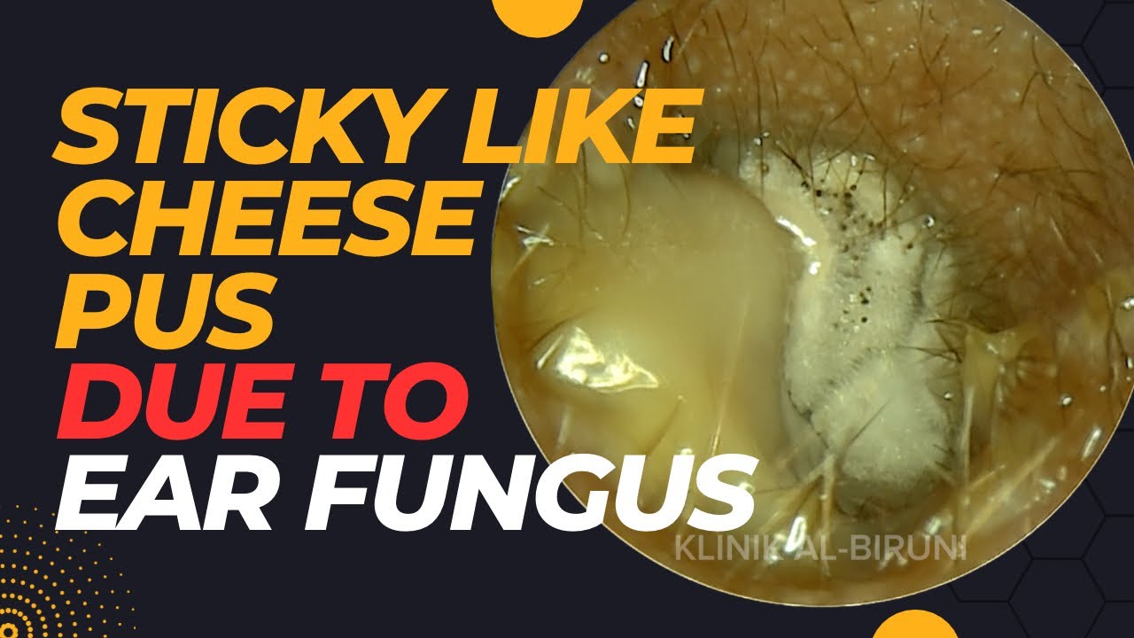 STICKY Like Cheese Pus Due To Ear Fungus - YouTube