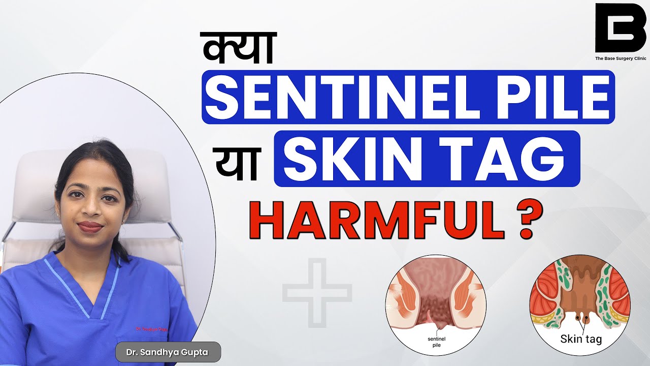Sentinel Pile or Skin Tag - SKIN OVER ANUS ? | सेंटिनल पाइल या स्किन ...