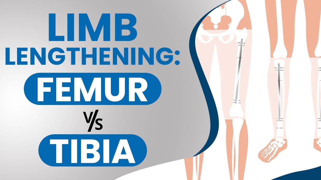 Limb Lengthening: Femur vs Tibia | How to choose | Explained by Dr ...