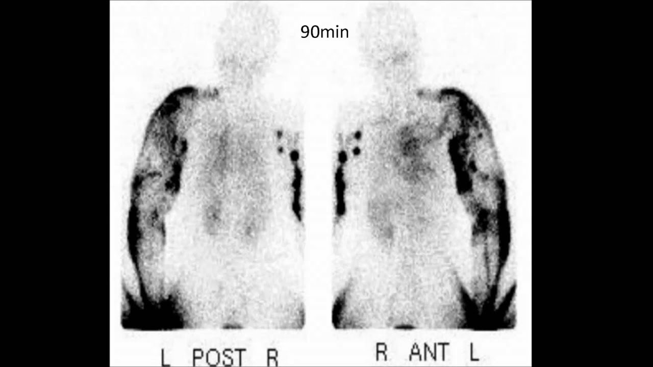 Lymphoscintigraphy for lymphedema patients -Lymphatic Surgery in Japan ...