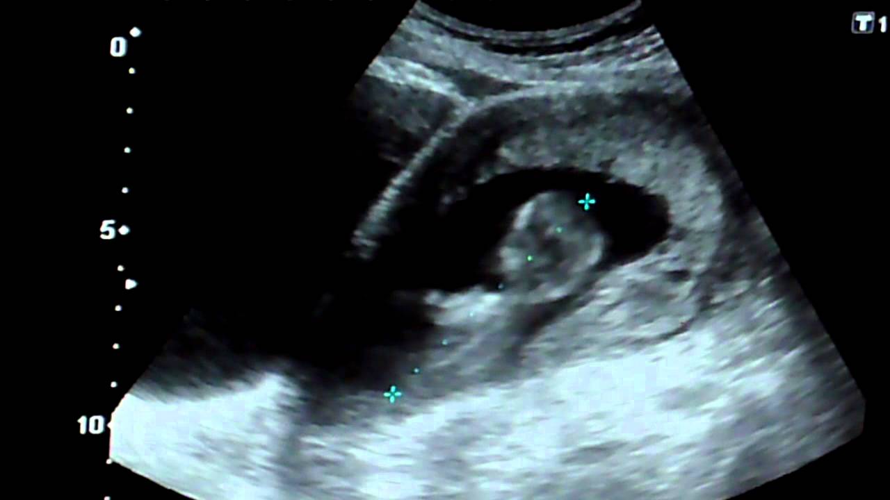 Mi bebe, 12 semanas - YouTube