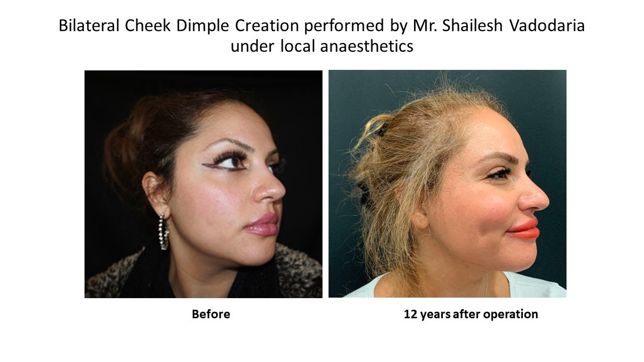 Dimple Surgery Gone Wrong The People Going To Extreme Lengths To Give