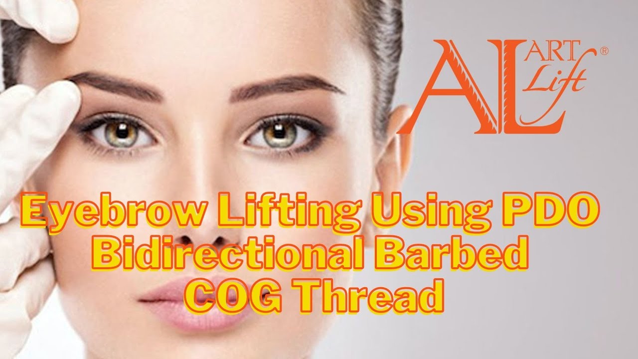 Eyebrow Lifting Using PDO Bidirectional Barbed COG Thread - YouTube