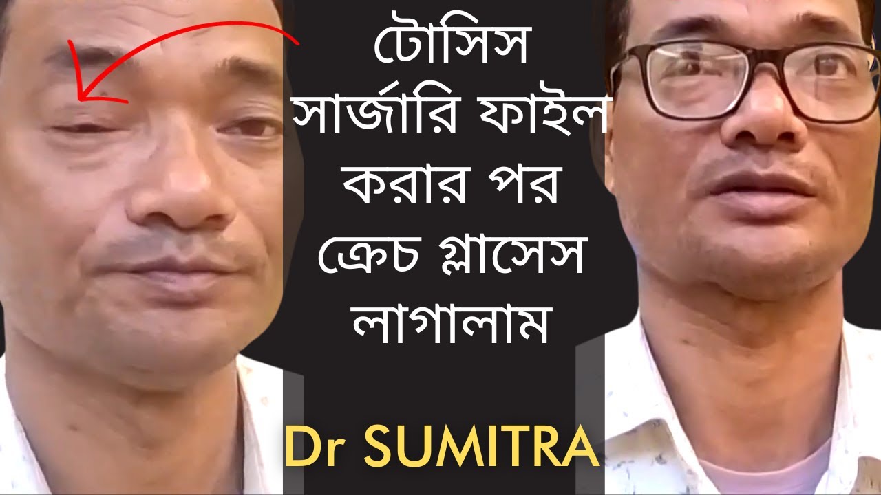 Ptosis surgery failed. Crutch glasses helped me | Custom made ptosis ...