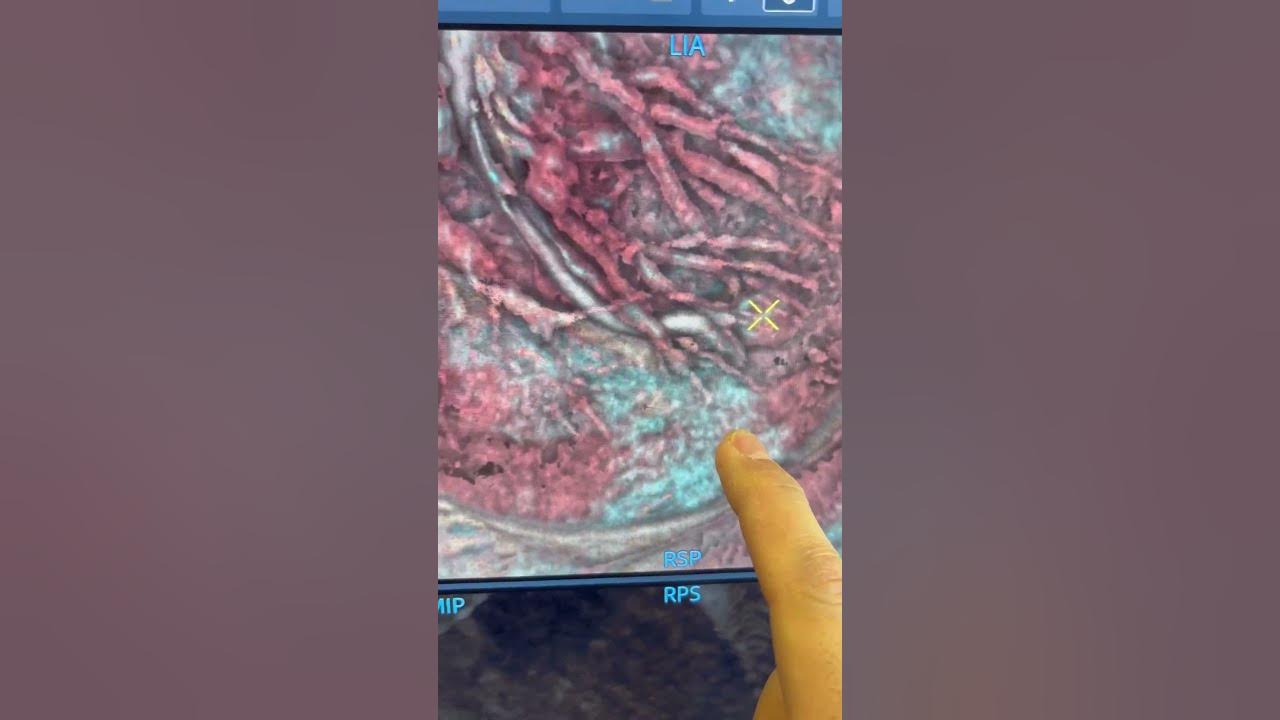 3D Carm & Illumisite - YouTube