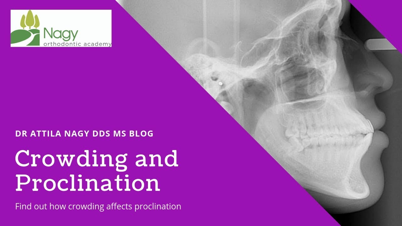 Evaluating crowding and proclination | Orthodontic Matters 27 - YouTube