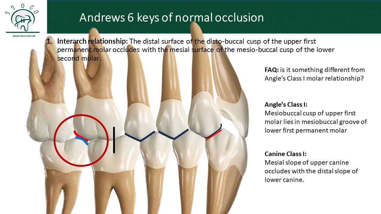 Andrew's 6 Keys of Normal Occlusion (Lesson 1 (1st key) ) - YouTube