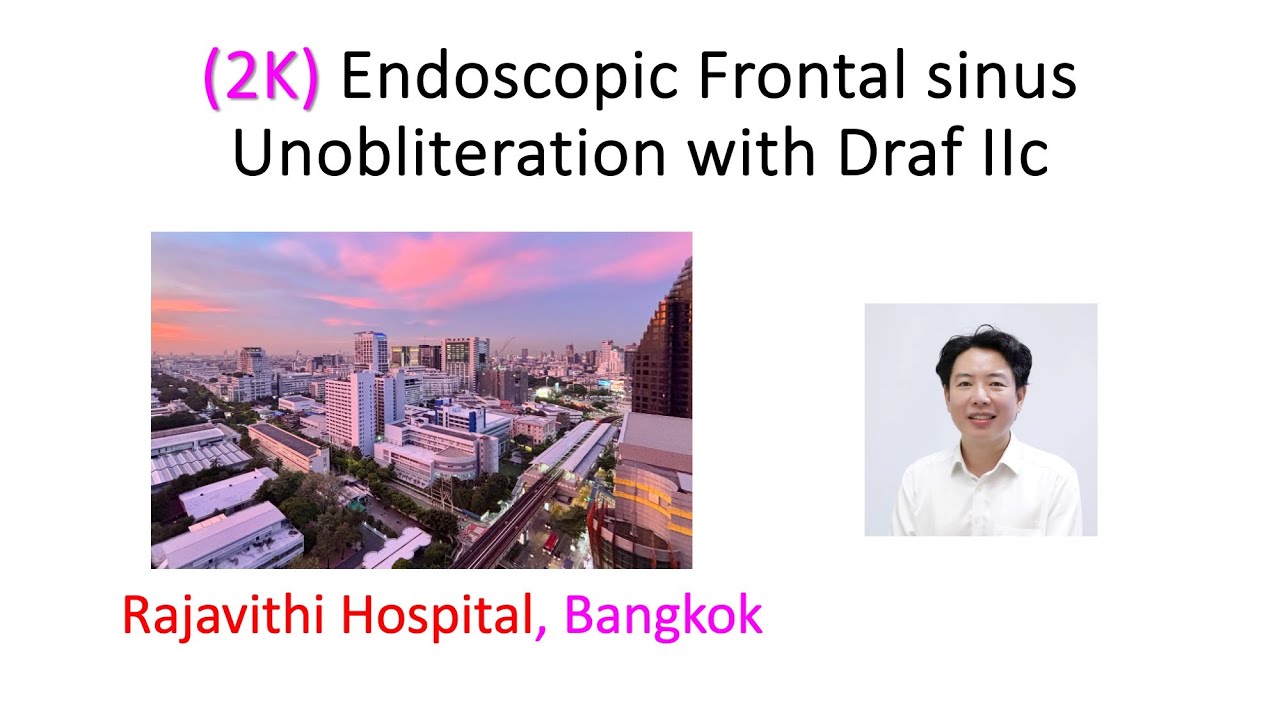 Endoscopic Frontal Sinus Unobliteration via Draf IIc - YouTube