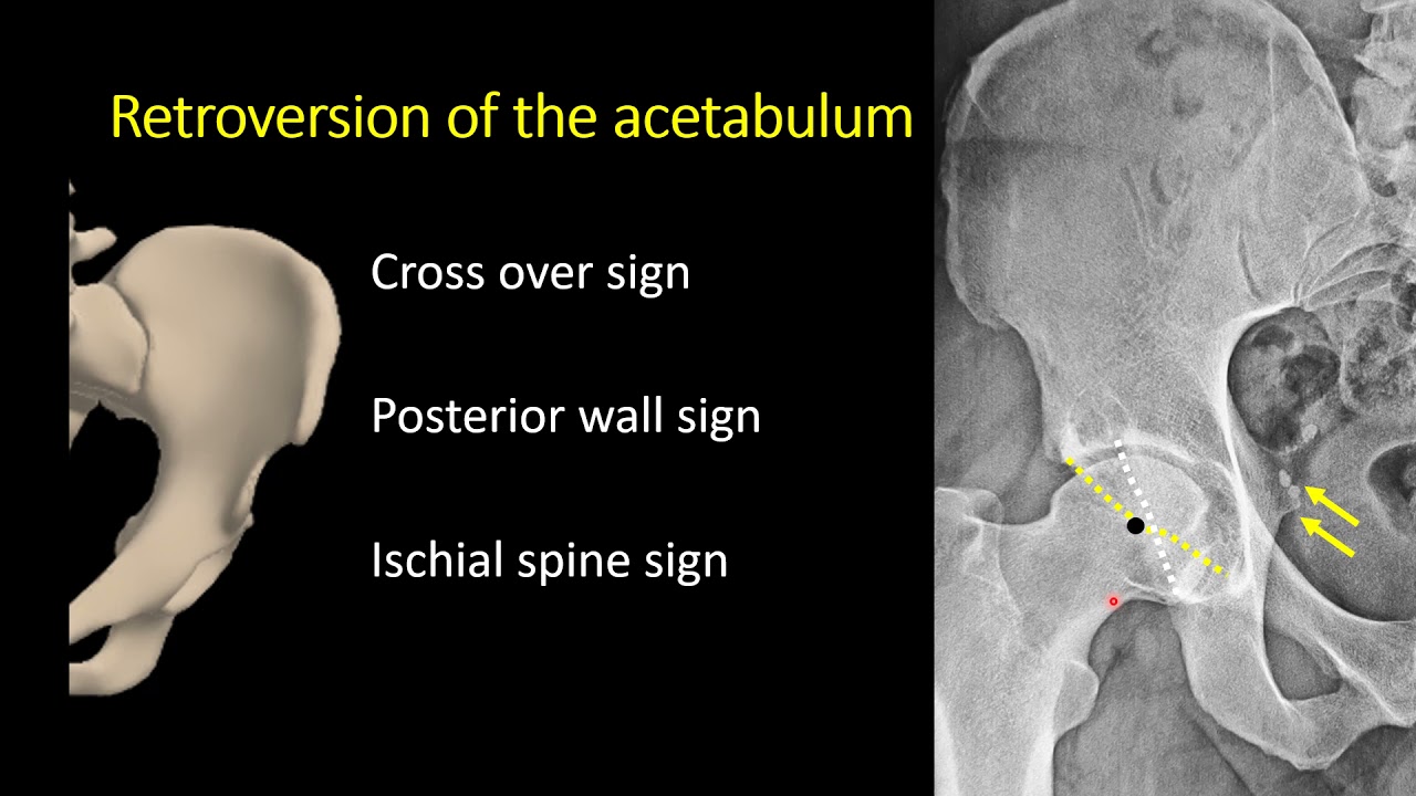 FAI Radiology - AAAZEEM - YouTube