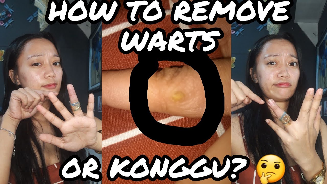 How to remove warts/kalunggo |Jherryl Manolong - YouTube