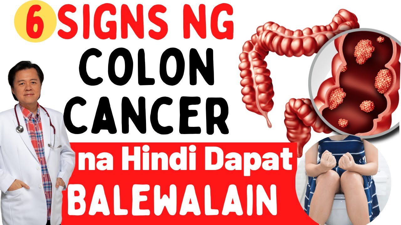 6 Signs ng Colon Cancer na Hindi Dapat Balewalain - Payo ni Doc Willie ...