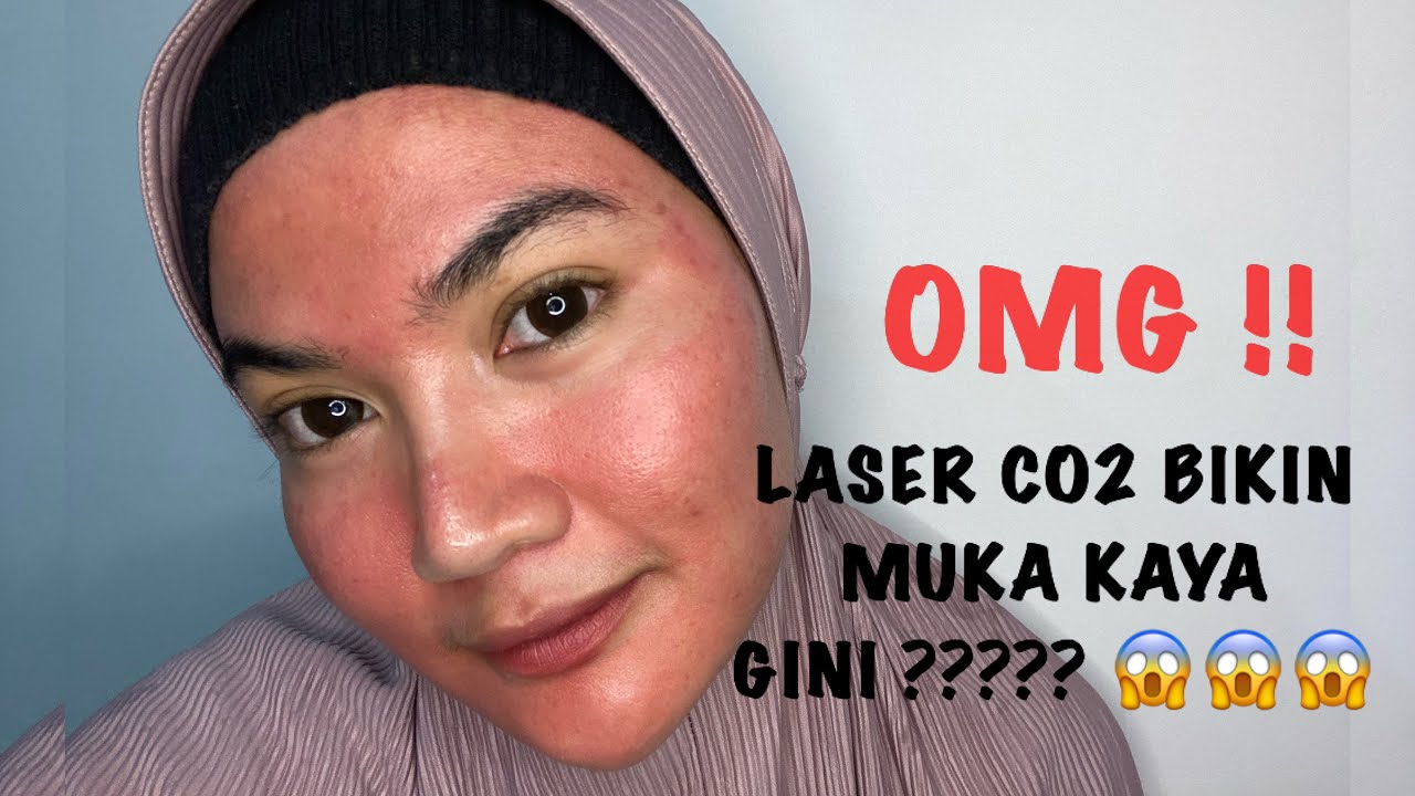 PERTAMA KALI LASER CO2 FRACTIONAL DI SW KLINIK BIKIN MUKA KAYA GINI ...
