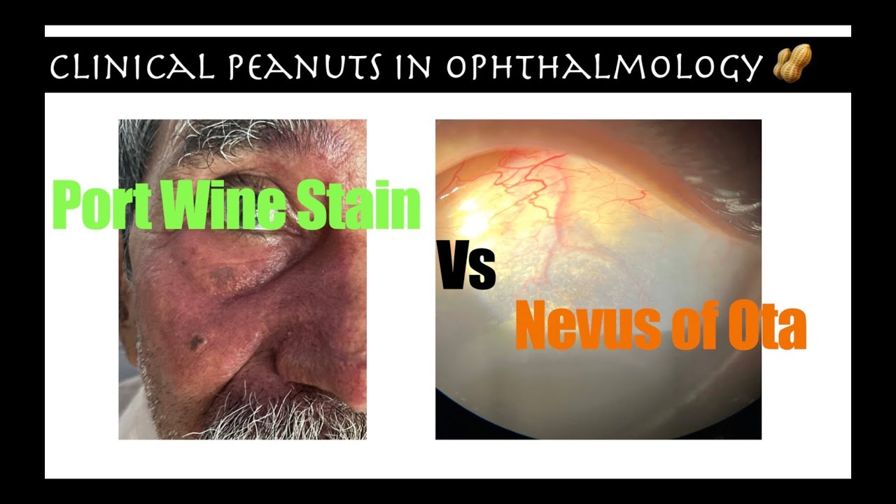 Nevus of Ota Vs Port Wine Stain - Pigmented lesions of the eye - YouTube