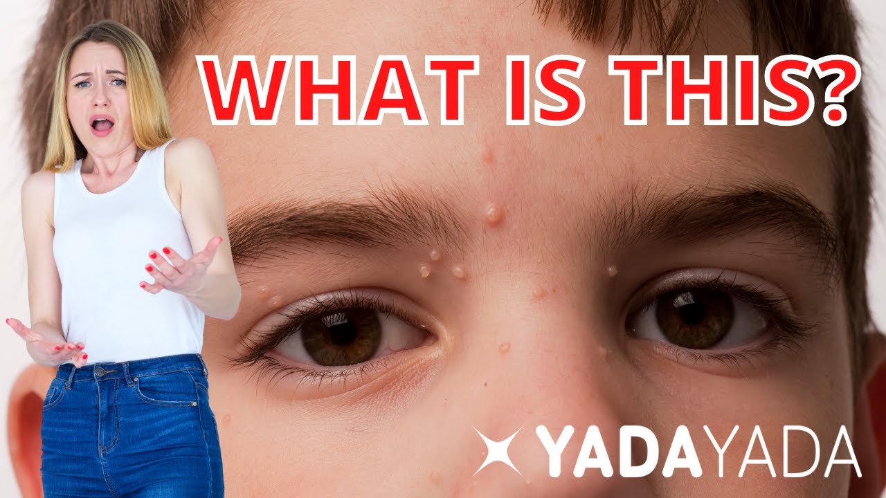 Molluscum Contagiosum - What are these pearly bumps on my child? - YouTube