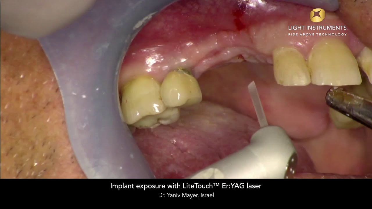 Implant exposure with LiteTouch™ Er:YAG laser - YouTube