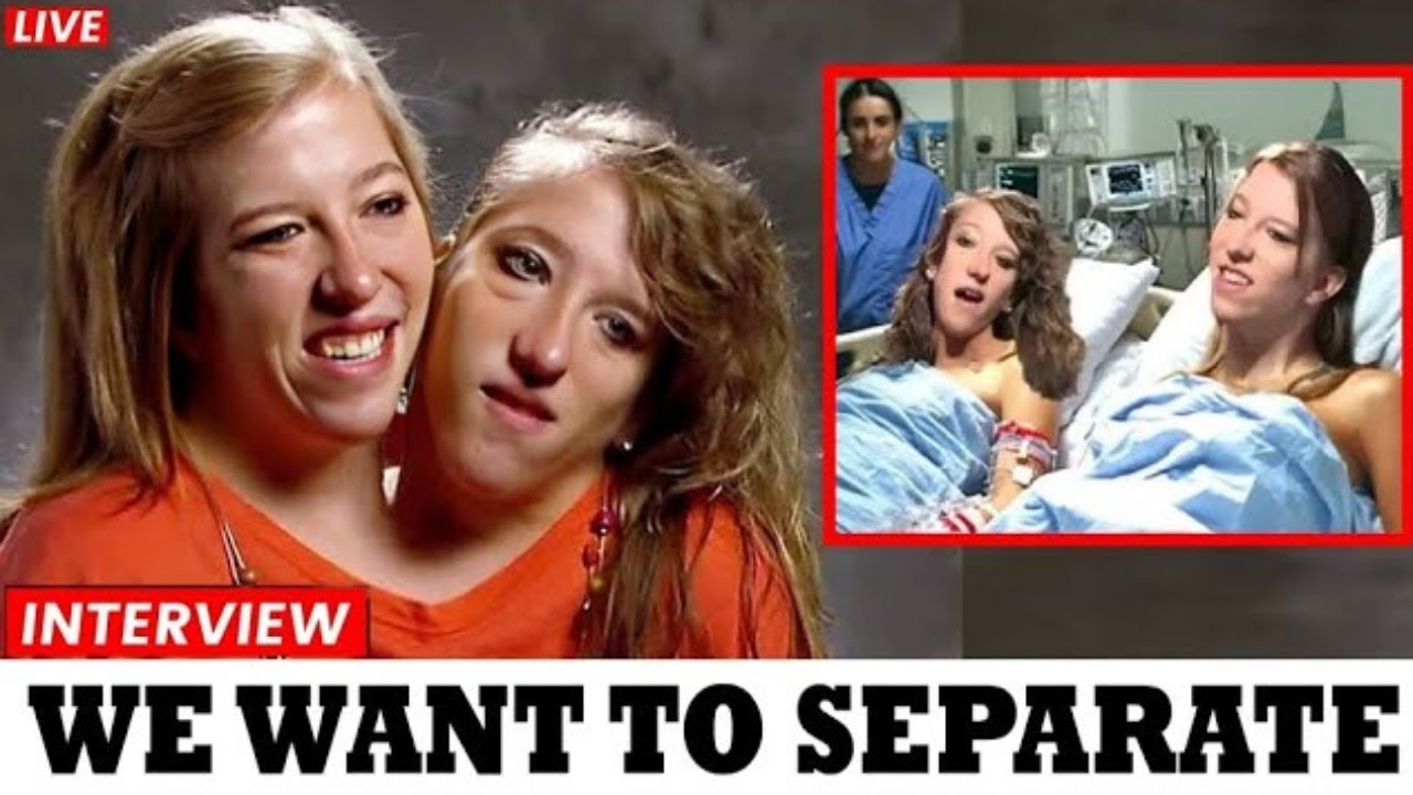 After the Surgery: Conjoined Twins Celebrate Their New Lives - YouTube