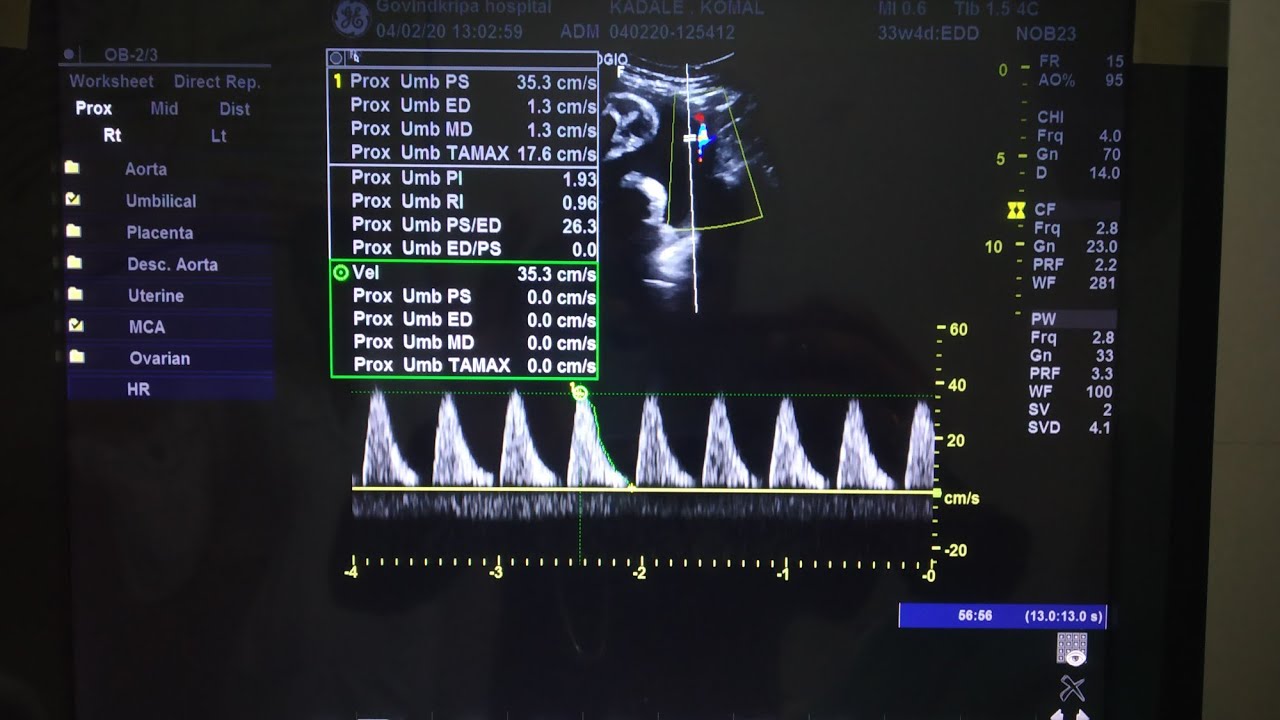 Absent diastolic flow in umbilical artery. - YouTube