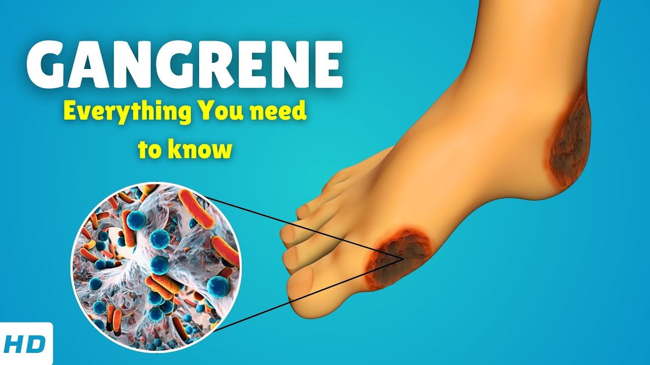 Gangrene – Types, Causes, Signs and Symptoms, Treatment & Prevention ...