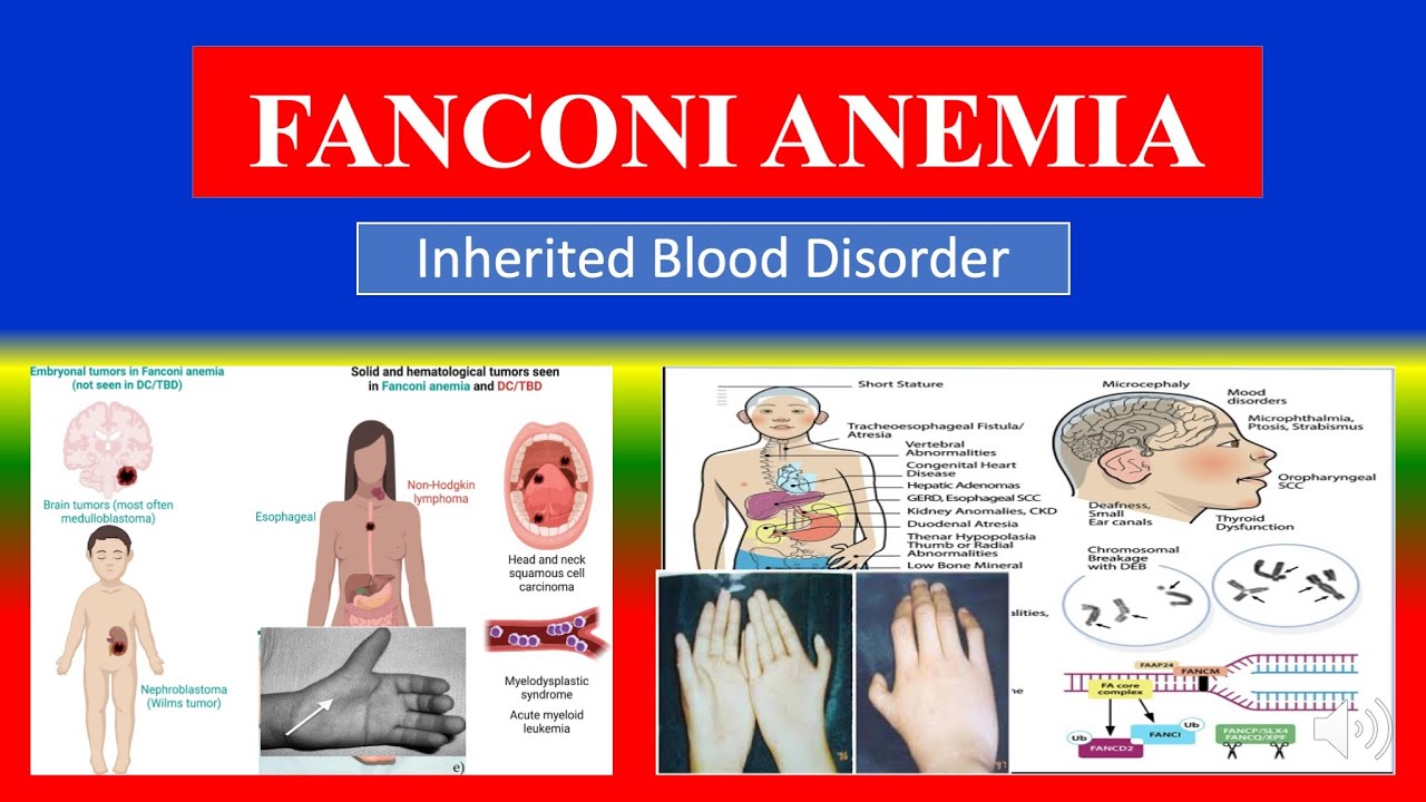 FANCONI ANEMIA - Definition, types, causes, pathophysiology, symptoms ...
