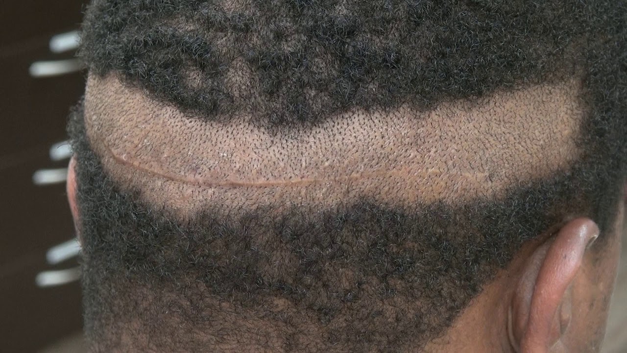 Dr. Diep Demontrates FUT Scar From Strip Harvesting Hair Transplant ...