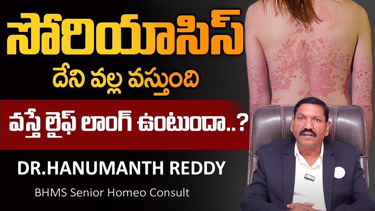 సోరియాసిస్ రావడానికి కారణం ఏంటి..? | Dr.Hanumanth Reddy About Psoriasis ...