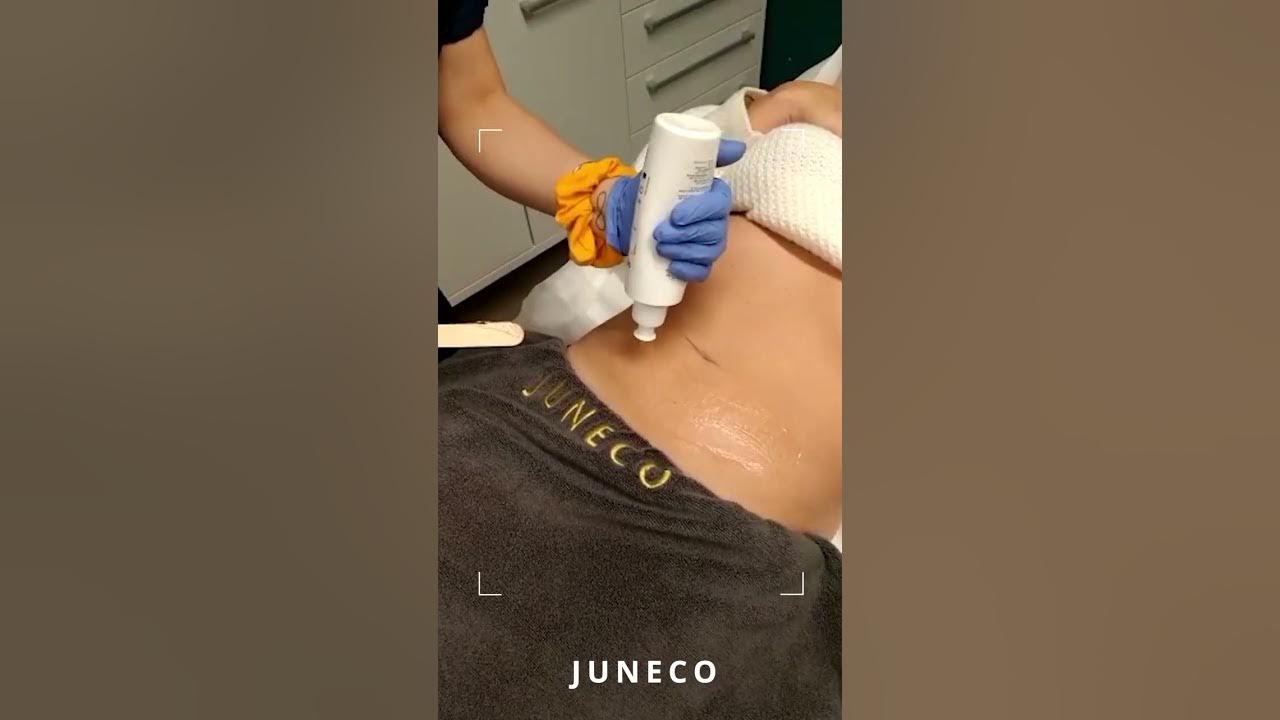 Criolipolisi addome: come avviene il trattamento - YouTube