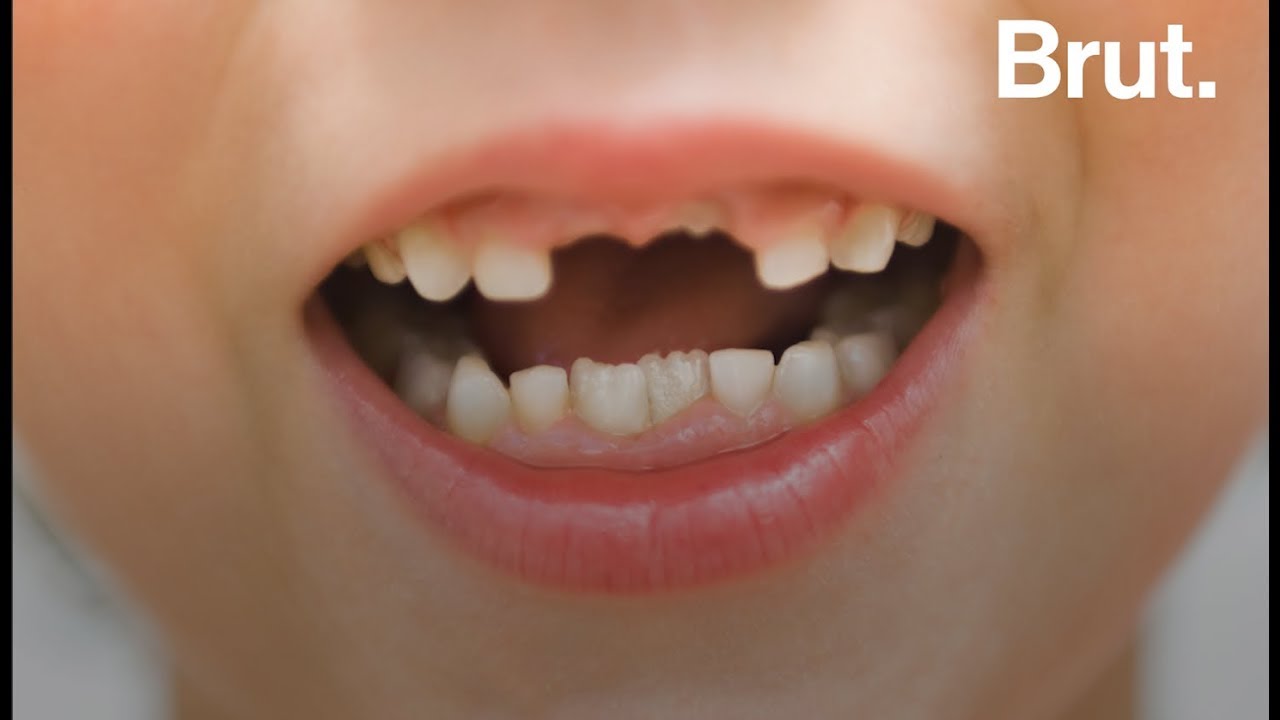 The Boy With 526 Teeth - YouTube