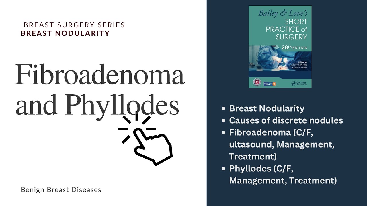 Fibroadenoma and Phyllodes|| Nodularity of breast: Fibroadenoma ad ...