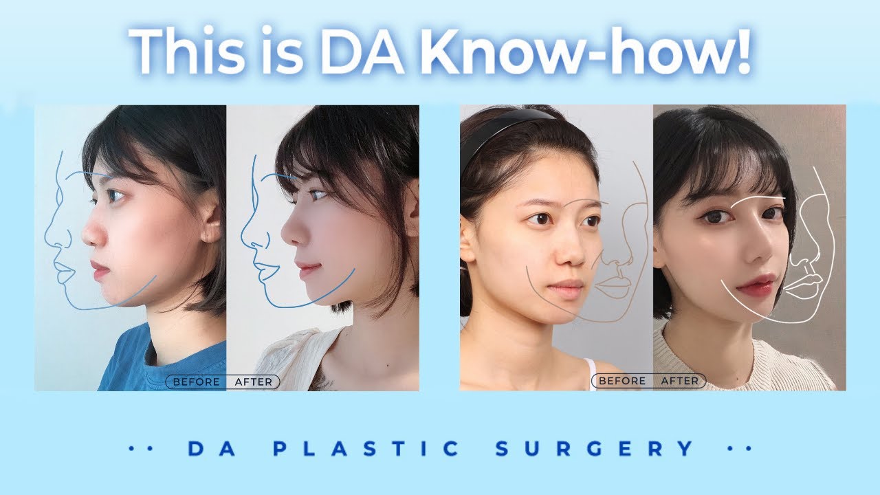 My Rhinoplasty, Facial Contouring and Eye Surgery at DA Plastic Surgery ...