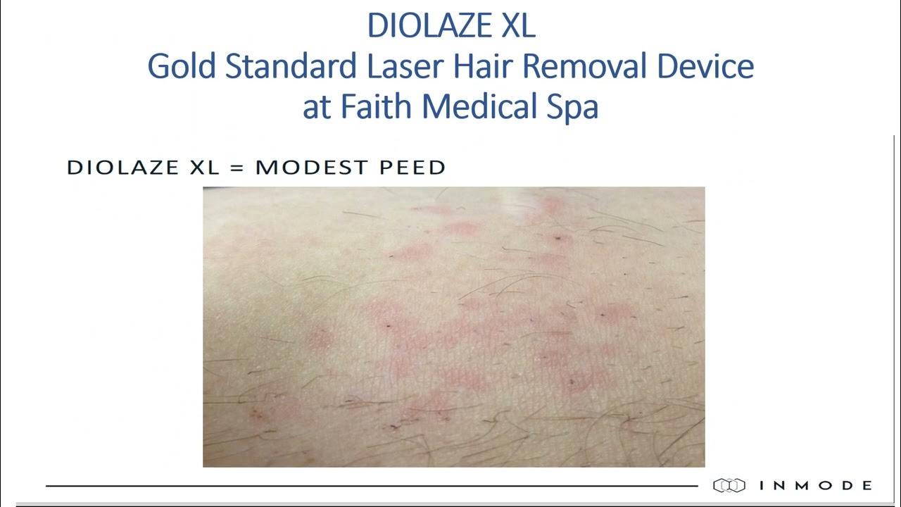 DIOLAZE Gold Standard Laser Hair Removal Device at Faith Medical Spa - YouTube