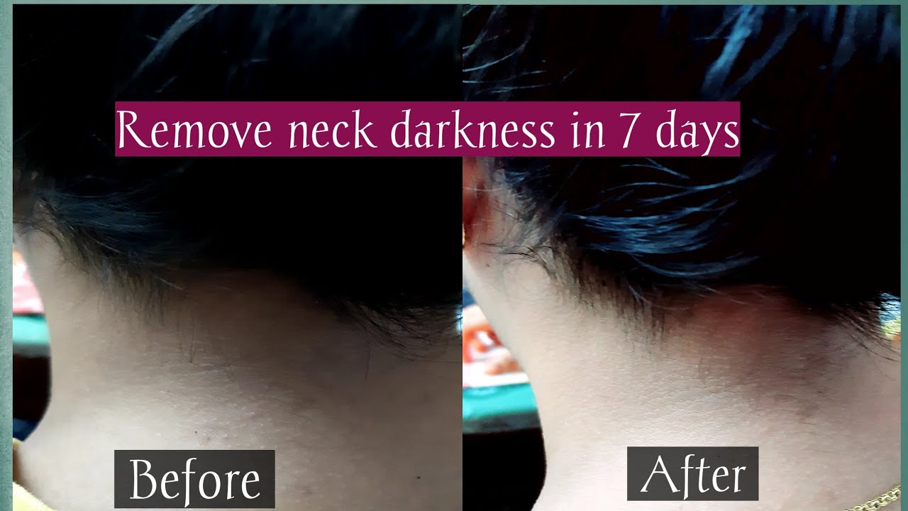 HOW TO REMOVE DARK NECK | REMOVE DARK NECK WITHIN 7 DAYS | BEAUTY ...