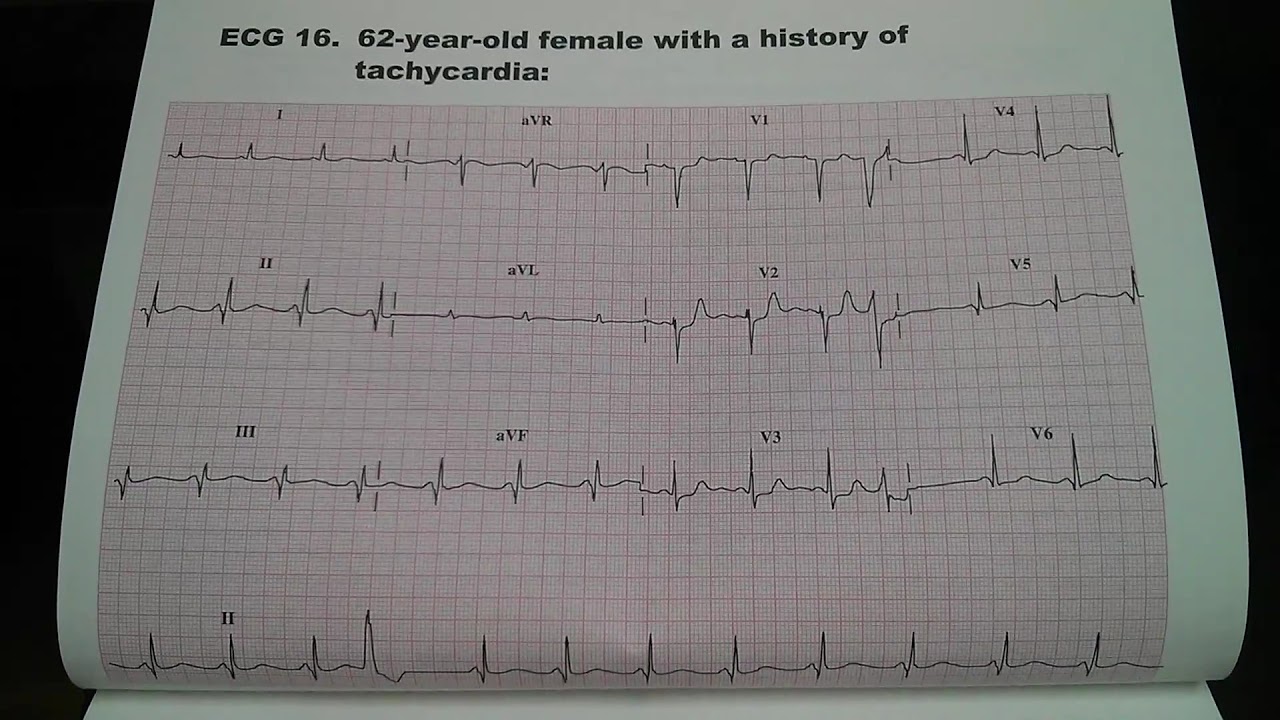 EKG ECG abnormality cardiology cardiologist electrocardiogram doctor ...