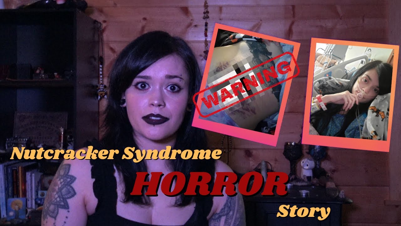 My Nutcracker Syndrome HORROR Story - YouTube