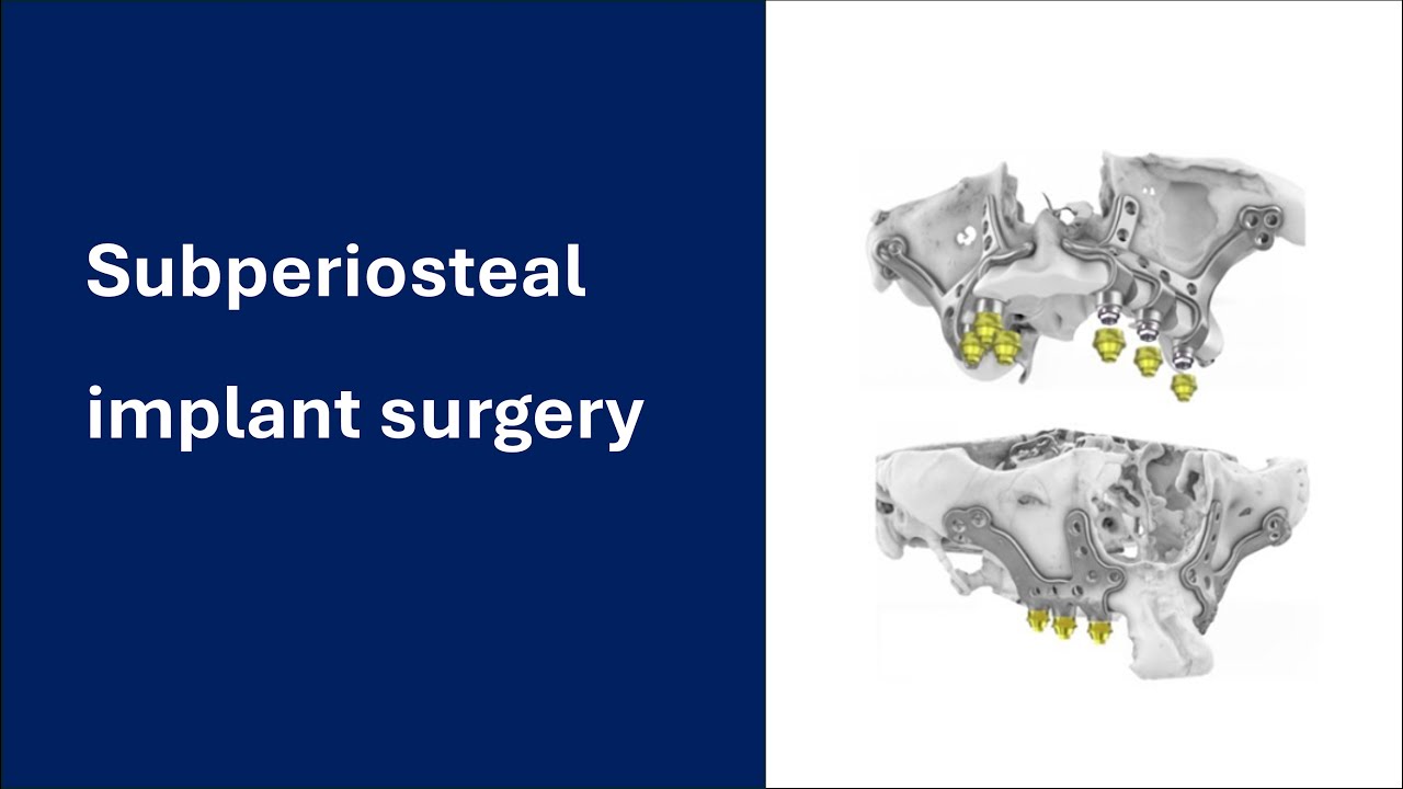 Subperiosteal implant surgery - YouTube