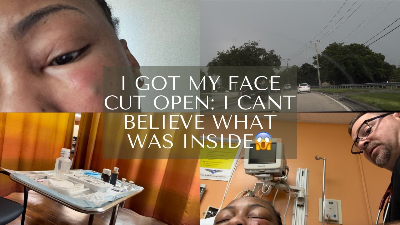 My face got cut open | YOU WONT BELIEVE WHAT WAS INSIDE😱 - YouTube