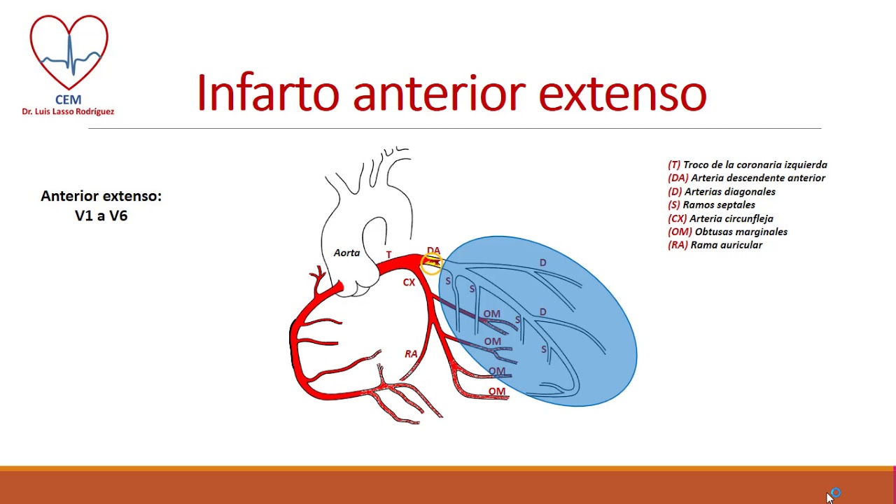 Electrocardiograma De Infarto De Miocardio Lateral