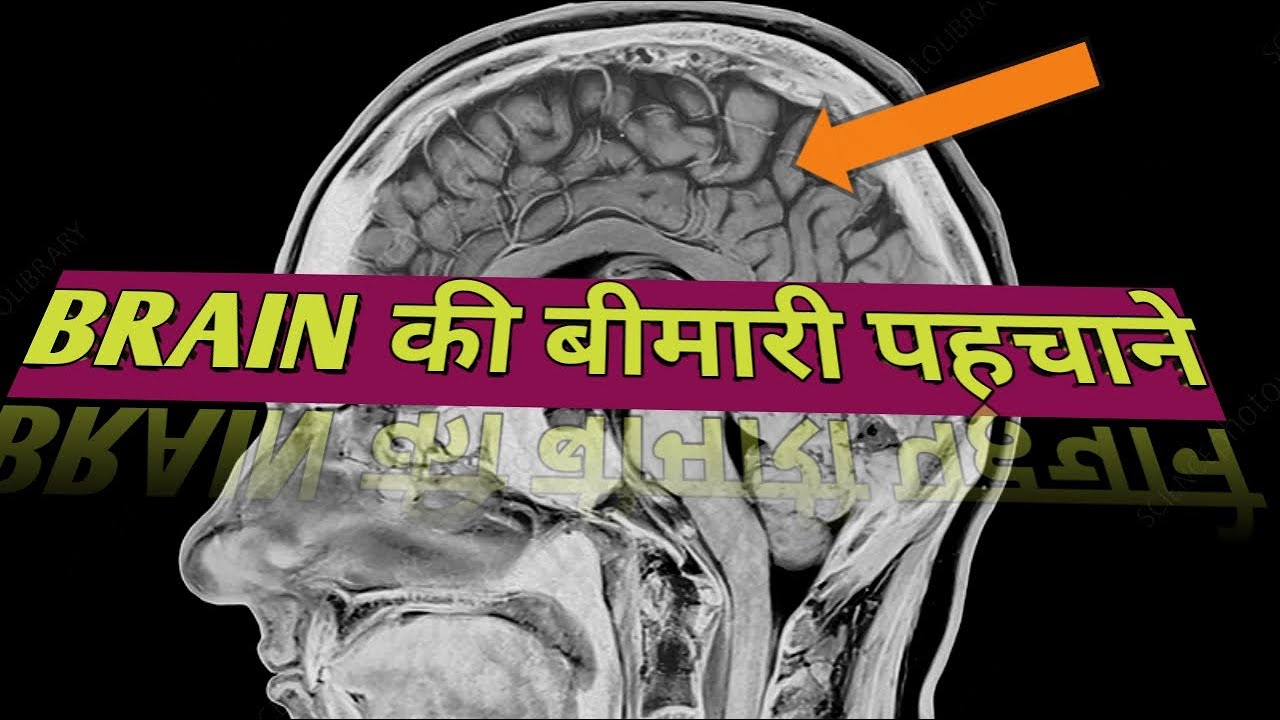 Mri Brain Pathology for Epilepsy with Brain anatomy in simple words ...