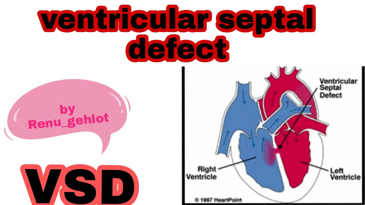 Ventricular septal defect (VSD) ||types of VSD||classification of VSD ...