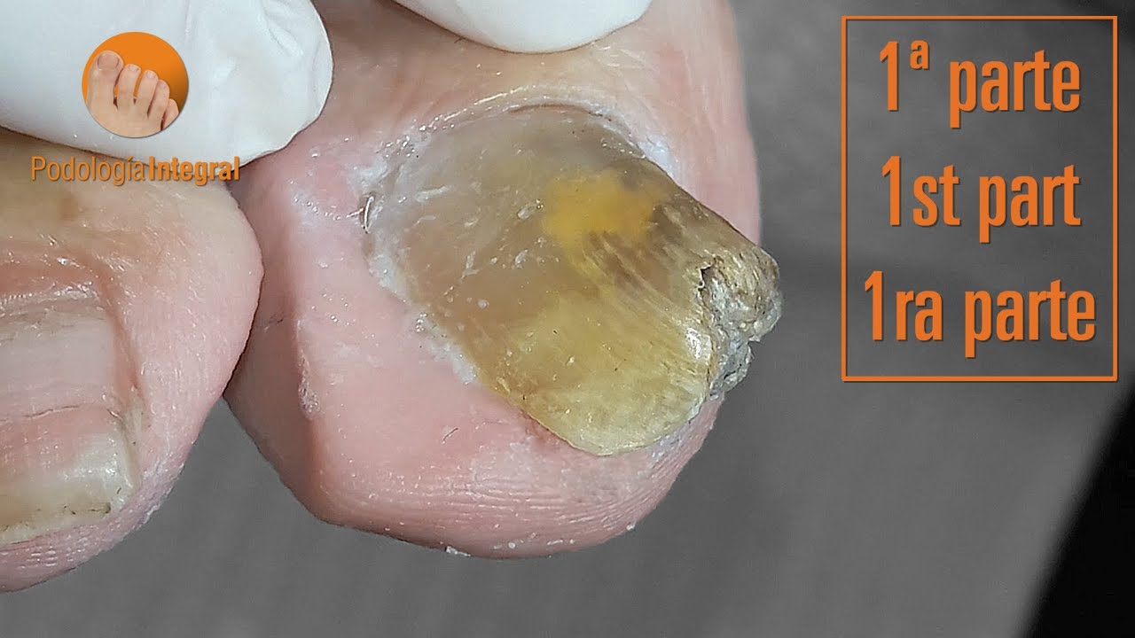 Onychomycosis, onychogryphosis and helomas (Part 1) #podologiaintegral ...