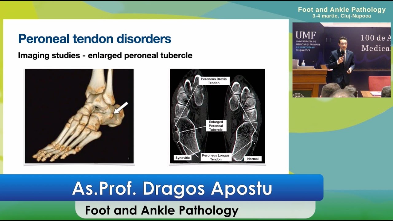 Peroneal tendon disorders - Dragos Apostu - Foot and Ankle Pathology ...