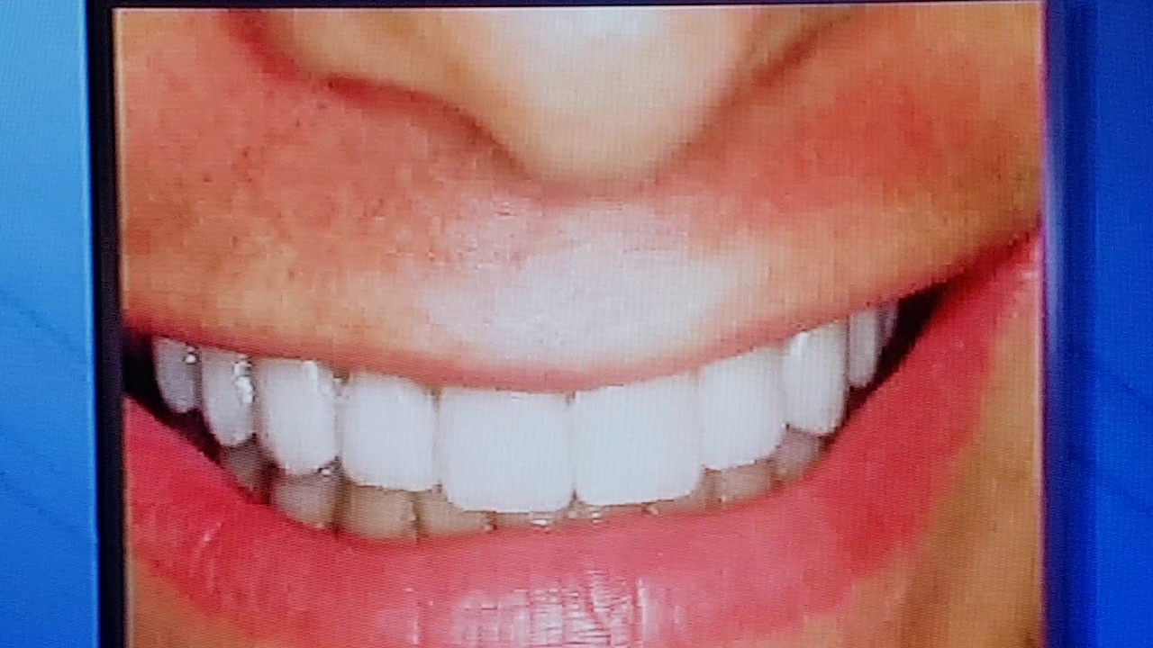 HealthPlex Dental Education - Bonding - YouTube