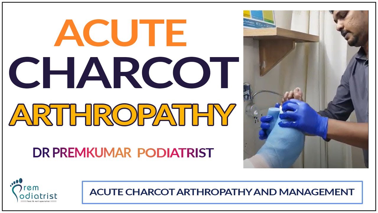 Charcot Arthropathy: Understanding and Managing Charcot Foot | Dr ...