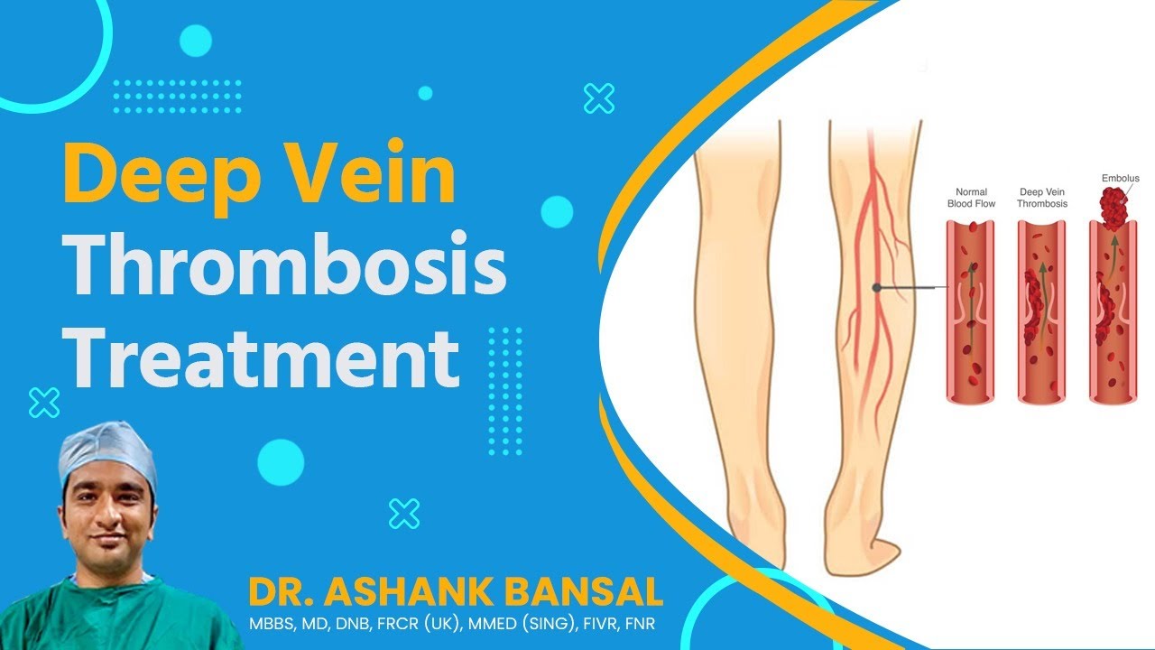 What is Deep Vein Thrombosis Treatment - By Dr.Ashank Bansal - YouTube