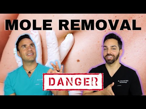 Can Honey Actually Remove Moles