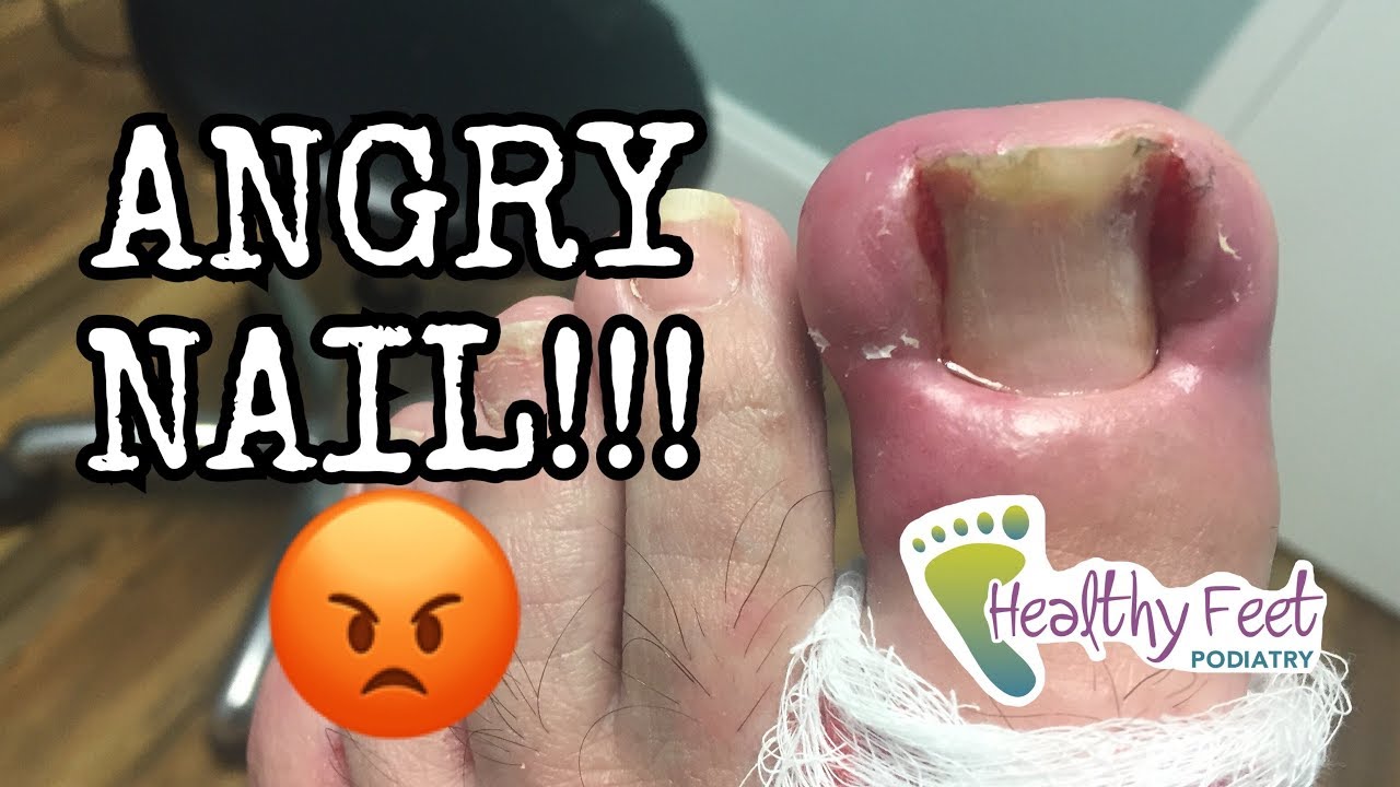 Toenail Tuesday: A Very Angry Ingrown Toenail. Infected Ingrown. - YouTube